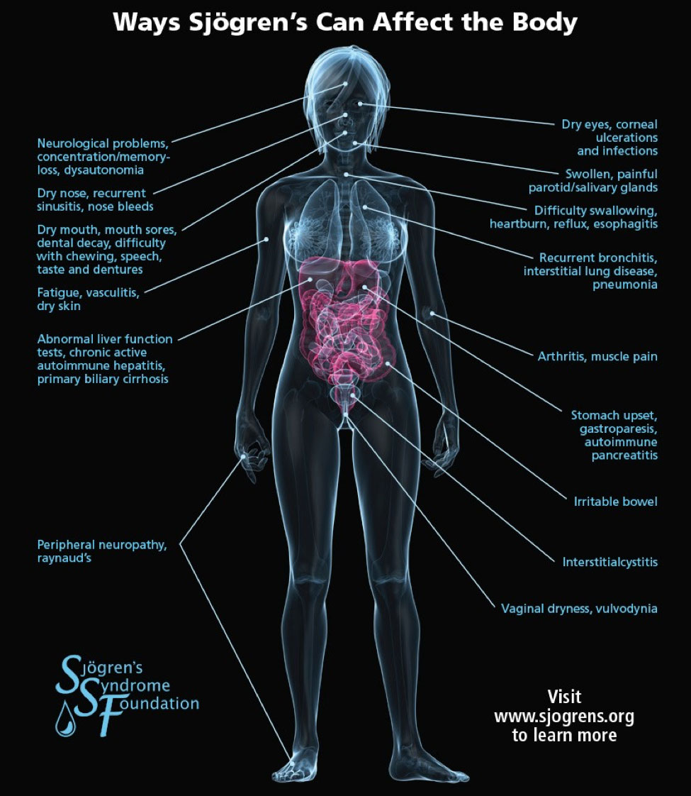 Sj gren s Syndrome Long Term Disability Mcdonald And Mcdonald